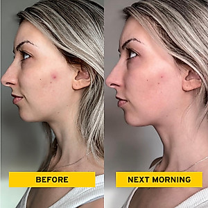 No BS Intensive Overnight Pimple Patches - Fast-Acting Acne Spot Treatment for Clear, Healthy Skin -Hydrocolloid, Salicylic Acid, Calamine (1 BOX of 36ct). Includes Free Skincare Samples