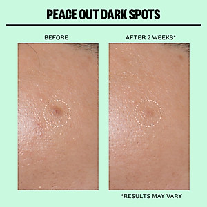 Peace Out Skincare Dark Spots. Dissolving Microstructure Dots to Reduce the Appearance of Dark Spots & Hyperpigmentation, Niacinamide Helps Reveal Clear, Even Skin (12 dots)