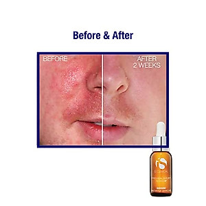 Pro-Heal Serum Advance+ Antioxidant-rich Vitamin C Serum, Vitamin E And Retinol For Redness, Rosacea And Inflammation