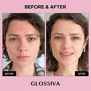 Glossiva Drying Lotion – Acne Spot Treatment, Blemish & Pimple Drying Solution with Overnight Results – 1.23 Fl Oz