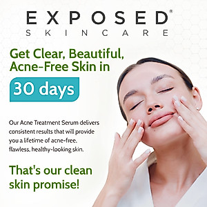 Exposed Skin Care Acne Treatment Serum Step 3 – Quickly Reduces Pimple Size and Redness - 12 Hour Spot Treatment - 3.5% Benzoyl Peroxide, Natural Green Tea & Tea Tree Oil