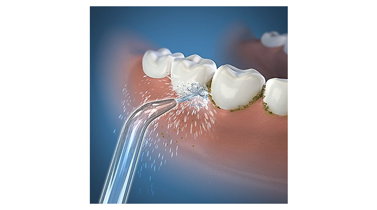 Waterpik Classic Jet Tip JT 100E for Deep Dental Clean | Improve Gum Health