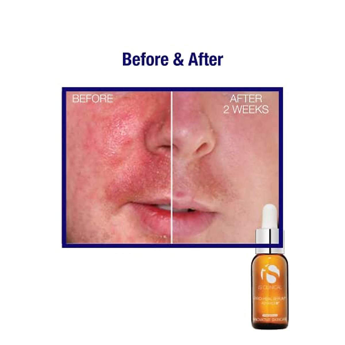 Pro-Heal Serum Advance+ Antioxidant-rich Vitamin C Serum, Vitamin E And Retinol For Redness, Rosacea And Inflammation