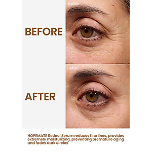 HOPEMATE Natural Facial Retinol Serum with Hyaluronic Acid& Vitamin E, New Skin Treatment Formula, Organic Anti Wrinkle Reducer, Anti Aging Moisturizer, Dark Circles, Scar, Sun Damage Corrector