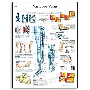3B Scientific VR3367L Glossy UV Resistant Laminated Paper Afeccion Por Varices, Varicosidades Anatomical (Varicose Veins Anatomical Chart,Spanish), Poster Size 20" Width x 26" Height, Yellow