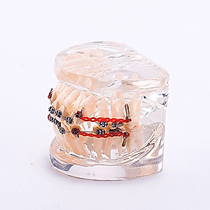 Easyinsmile Dental Orthodontic Treatment Model Teeth/Tooth/Denture Model with Braces for Dentist Studying Researching and Patient Education (Metal Bracket)