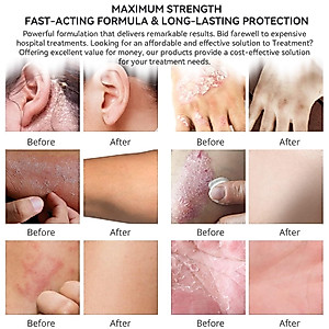 Heat Rash Itch Relief, Extra Strength Cream, Jock Itch, Athlete's Foot Hand Skin, Tinea Versicolor, Armpit, Itchy Feet, Psoriasis, Scalp Dandruff, Fast Relief for Eczema, Rosacea, 24h Soothing Treat