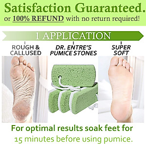 Dr. Entre's Pumice Stone for Feet 4 Pack: Callus Remover, Dead Skin Scraper, Exfoliator for Scrubber Use, Pedicure Tools, Cracked Heels Foot Care