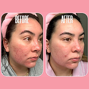 Glycolic Acid Pads with Vitamin C - Toner Pads for Face Cleansing With Tea Tree Oil - Exfoliating Pads with 20% AHA & Vitamins E, B3, B5 - Facial Peel Resurfacing Pads, Glycolic Acid Peel (50)