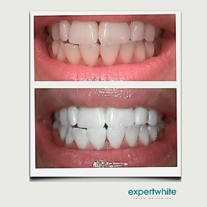 Expertwhite Teeth Whitening Gel Refills (6-gels). Made USA. 44 percent Carbamide Peroxide Tooth Bleaching Gel bleach For Invisalign style trays, Dental Grade Tooth Whitener. 6 syringes