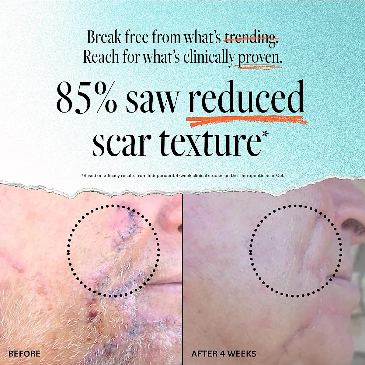 Derma E Scar Gel – Scar Treatment for Face – Hydrating Gel for Acne Scars, Burns & Stretch Marks with Panthenol & Allantoin, 2 oz