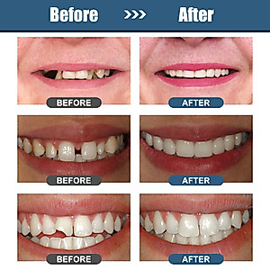 Tooth Repair Kit, Moldable Tooth Replacements Kit for Fixing, Dental Care Kit Filling Fake Teeth DIY at Home, Restoring Your Confident Smile