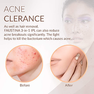 FAUSTINA 3-in-1 IPL (3 Lamps 1,500,000 Shots) Hair Removal, Skin Rejuvenation, and Acne Clearance Device - Completely Painless - Full Results After 3-7 Treatments - Free Pouch & Sunglasses.