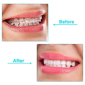 BBTO 60 Pieces Aligner Tray Seaters for Chompers Orthodontic Aligner, 6 Colors