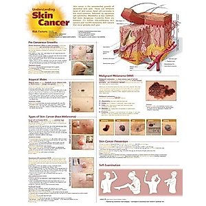 Understanding Skin Cancer Anatomical Chart