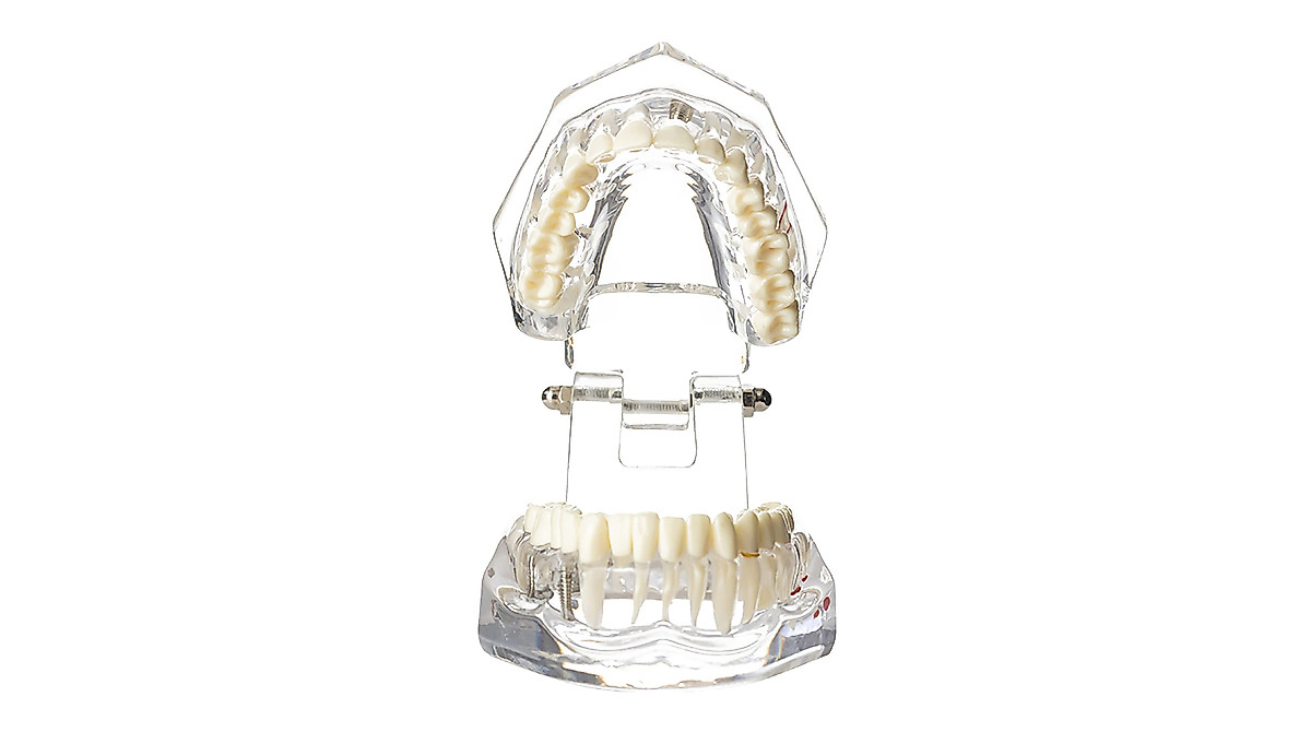 Dentalmall Implant Typodont Model for Education