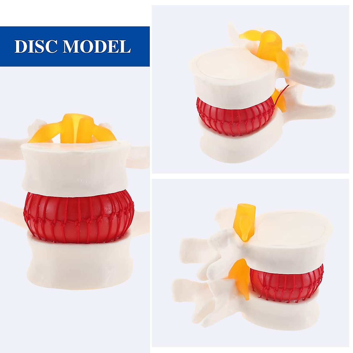 ASINTOD Human Anatomy Lumbar Disc Herniation Model,A Model Showing The Anatomy of Human Lumbar Disc, An Excellent Choice for Teaching and Learning The Human Lumbar Spine