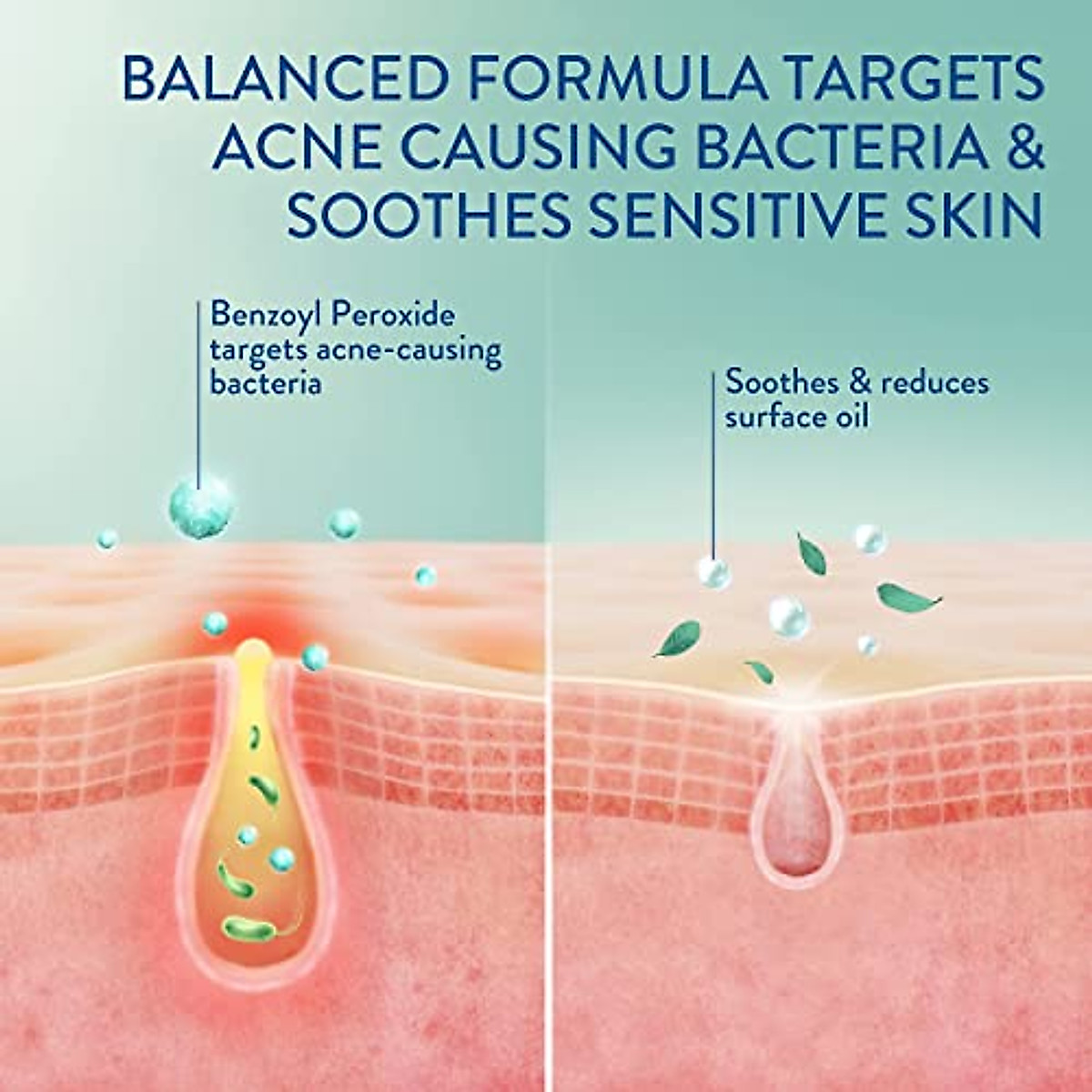 Cetaphil Gentle Clear Complexion-Clearing BPO Acne Cleanser with 2.6% Benzoyl Peroxide, Creamy and Soothing for Sensitive Skin, Suitable for All Skin Types, 4.2oz