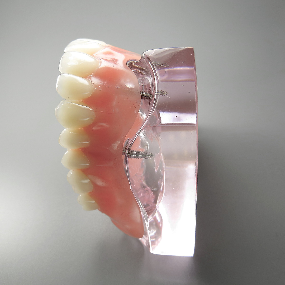 Dental Model Overdenture Upper Teeth 4 Implants Demo for Teaching and Studying