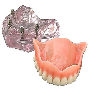Dental Model Overdenture Upper Teeth 4 Implants Demo for Teaching and Studying