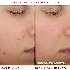 IT Cosmetics Bye Bye Breakout 2% Salicylic Acid Acne Treatment Serum, Helps Reduce Pimples in 3 Days & Fades Look of Post-Acne Marks in 8 Weeks, Facial Skin Care Product with 3% Lactic Acid - 1 fl oz