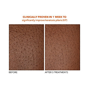 Dr Dennis Gross Alpha Beta Exfoliating Body Treatment | Multi-Tasking Powered by AHA/BHAs for Smooth, Hydrated Skin While Improving Ingrown Hairs, Keratosis Pilaris, and Blemishes | 8 Textured Towels