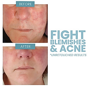 Vitamin C Serum 20% For Face, Pure Vitamin C Face Serum for Wrinkles, Acne, Dry Skin, and Dark Spots - Facial Vitamin C Serum (1oz)