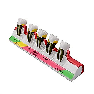 Ultrassist Dental Periodontal Disease Model, Dental Teeth Model for Dental Tooth Anatomy Study, Doctor-Patient and Oral Care Education