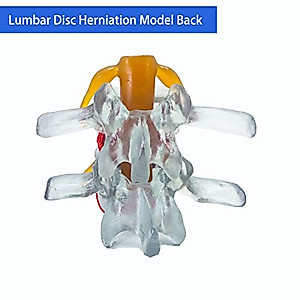 Veipho Human Anatomical Lumbar Disc Herniation Model, Transparency Lumbar Disc Herniation Model, Lumbar Disc Model for Teaching and Demonstrating