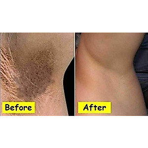 TOWELL Crema Aclaradora Para Piel Manchas En Cara Axilas Cuello Entrepierna