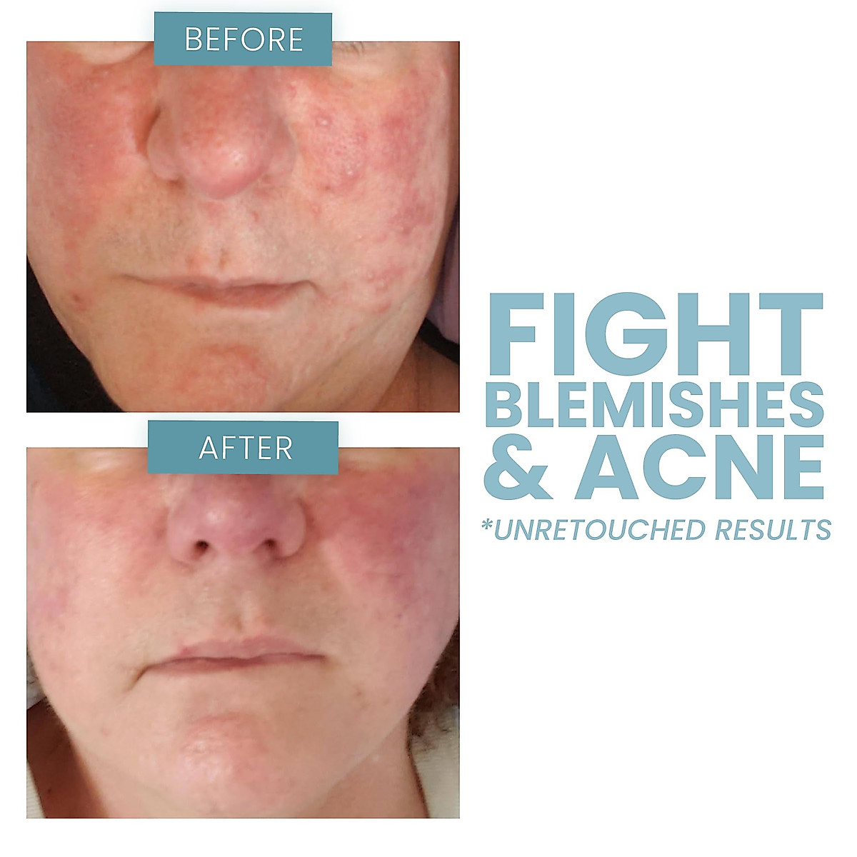 Vitamin C Serum 20% For Face, Pure Vitamin C Face Serum for Wrinkles, Acne, Dry Skin, and Dark Spots - Facial Vitamin C Serum (1oz)