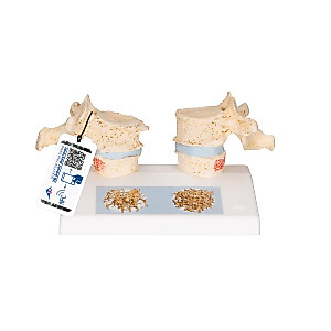 3B Scientific A95 Osteoporosis Model - 3B Smart Anatomy